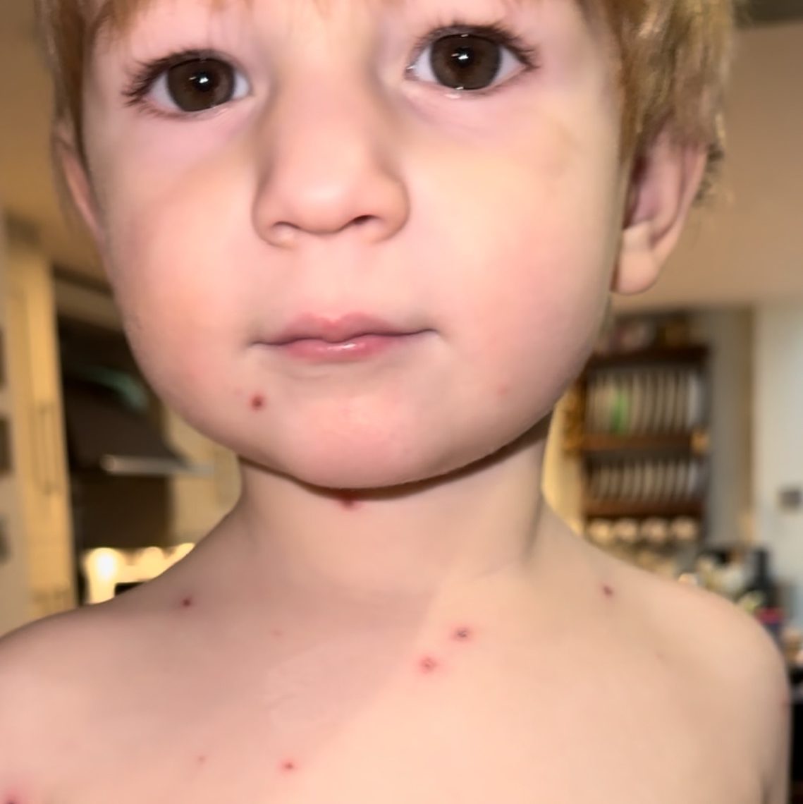 Pox Parties Explained: Risks vs. Benefits for Kids – The Science Baby