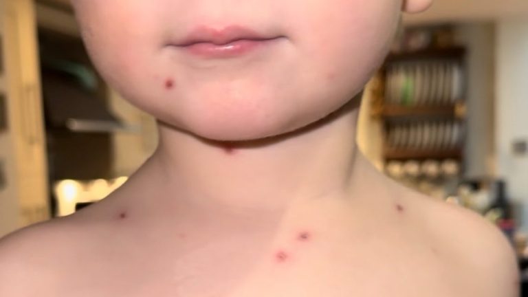 Chicken Pox Vaccine Rollout in the UK: Why Has It Taken So Long? – The ...
